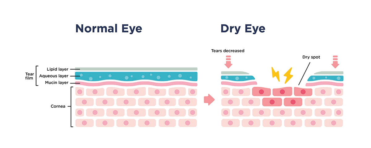 As we age, these glands can get obstructed with bacteria, cholesterol ...